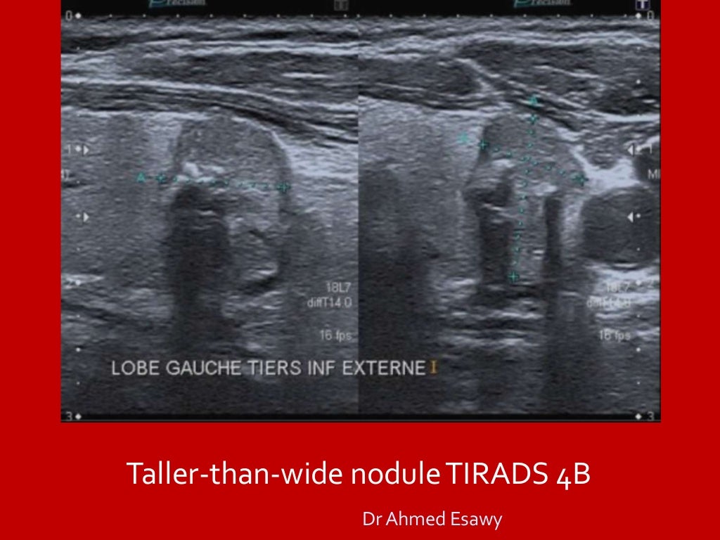 TIRADS (thyroid nodule imaging reporting and data system) Dr Ahmed E…