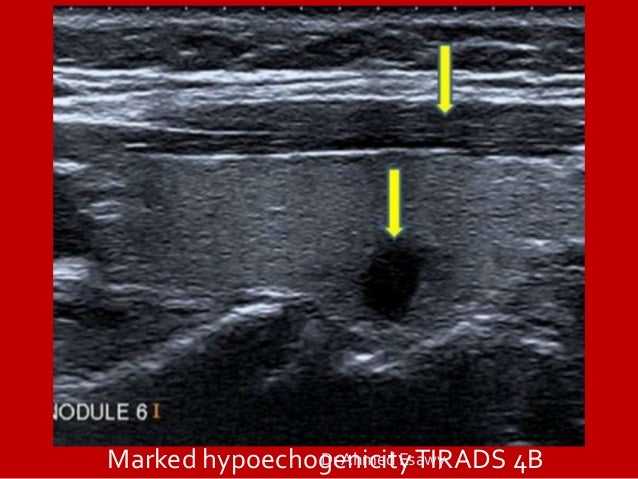 TIRADS (thyroid nodule imaging reporting and data system) Dr Ahmed E…
