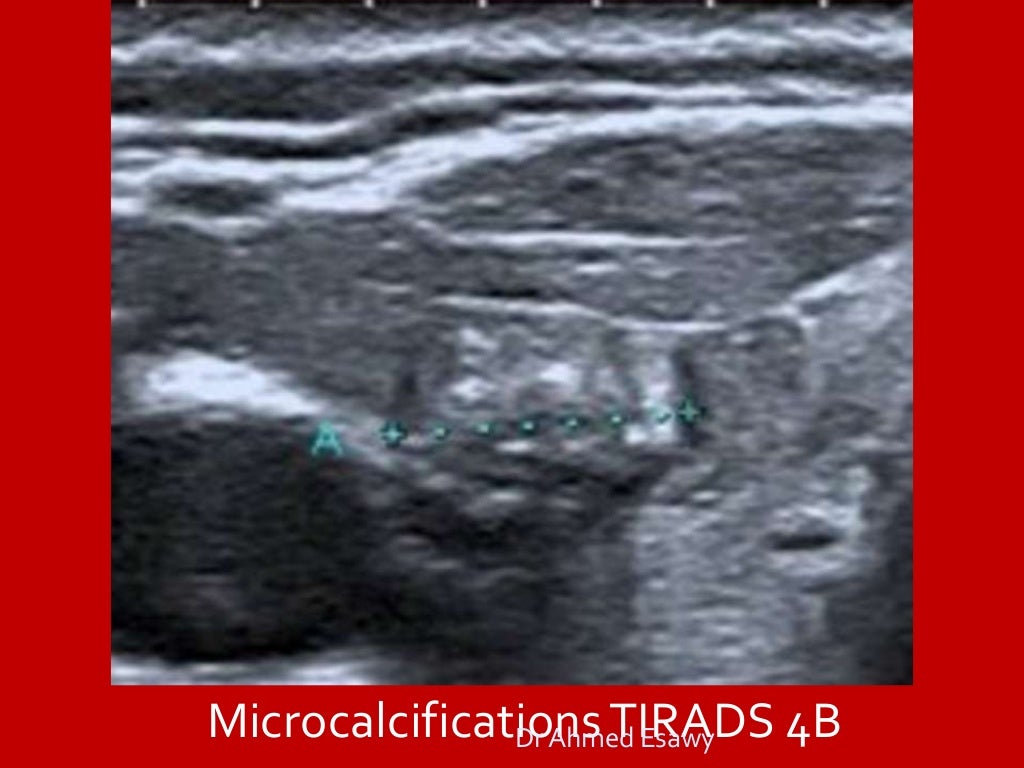 TIRADS (thyroid nodule imaging reporting and data system) Dr Ahmed E…