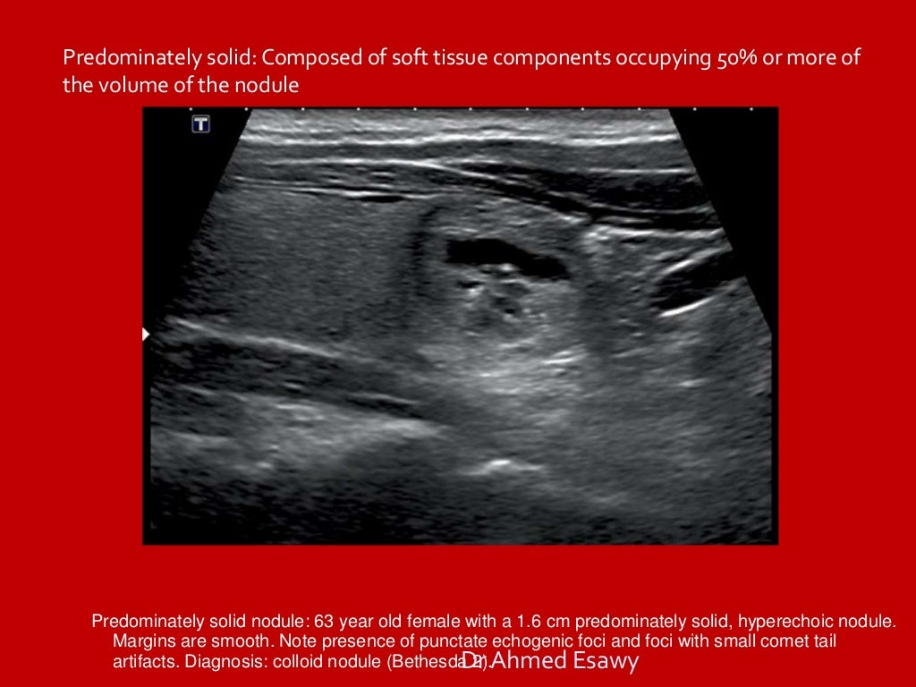 TIRADS (thyroid nodule imaging reporting and data system) Dr Ahmed E…
