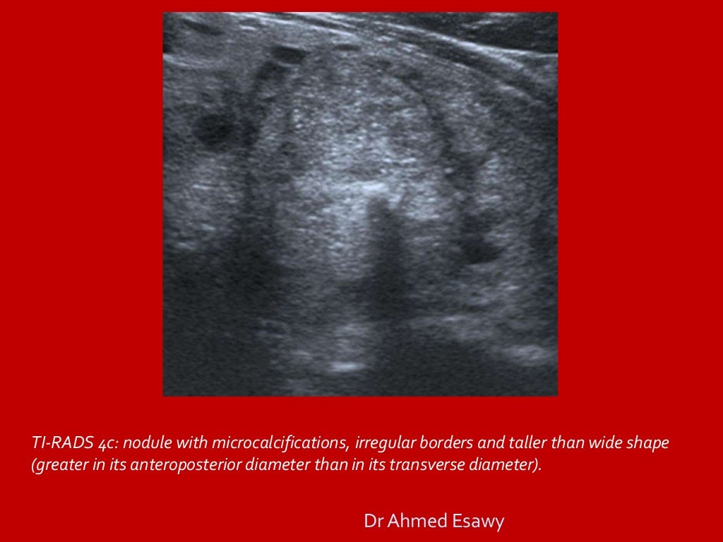TIRADS (thyroid nodule imaging reporting and data system) Dr Ahmed E…
