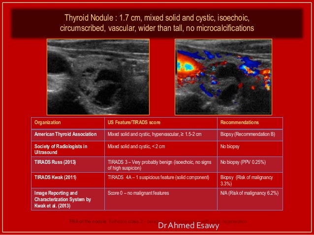 TIRADS (thyroid nodule imaging reporting and data system) Dr Ahmed E…