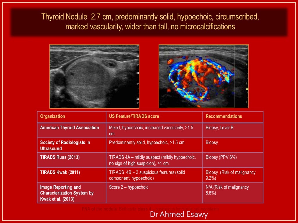 TIRADS (thyroid nodule imaging reporting and data system) Dr Ahmed E…