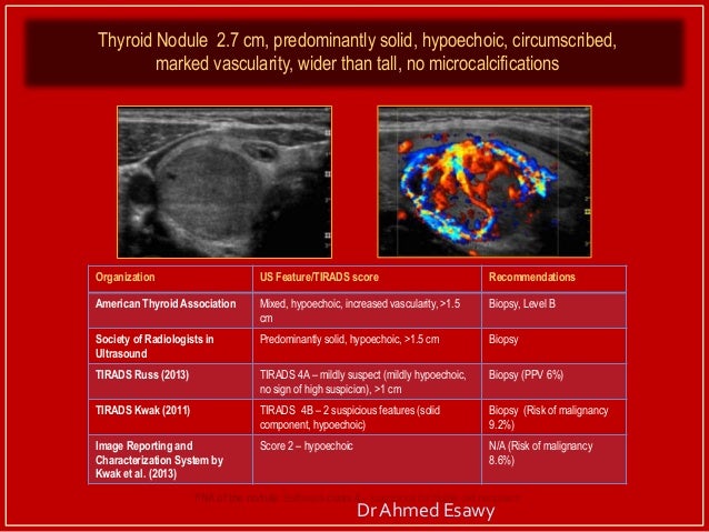 Tirads Thyroid Nodule Imaging Reporting And Data System Dr Ahmed E…