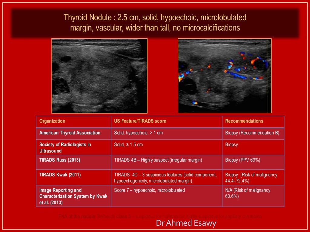 TIRADS (thyroid nodule imaging reporting and data system) Dr Ahmed E…