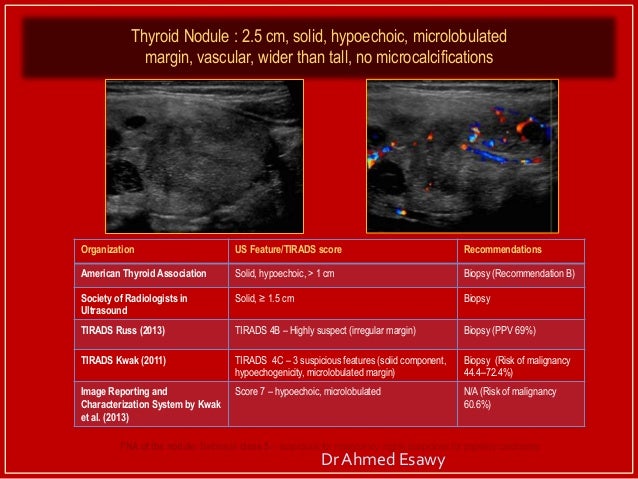 TIRADS (thyroid nodule imaging reporting and data system) Dr Ahmed E…