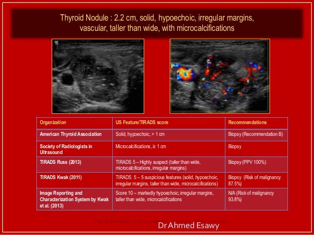 TIRADS (thyroid nodule imaging reporting and data system) Dr Ahmed E…