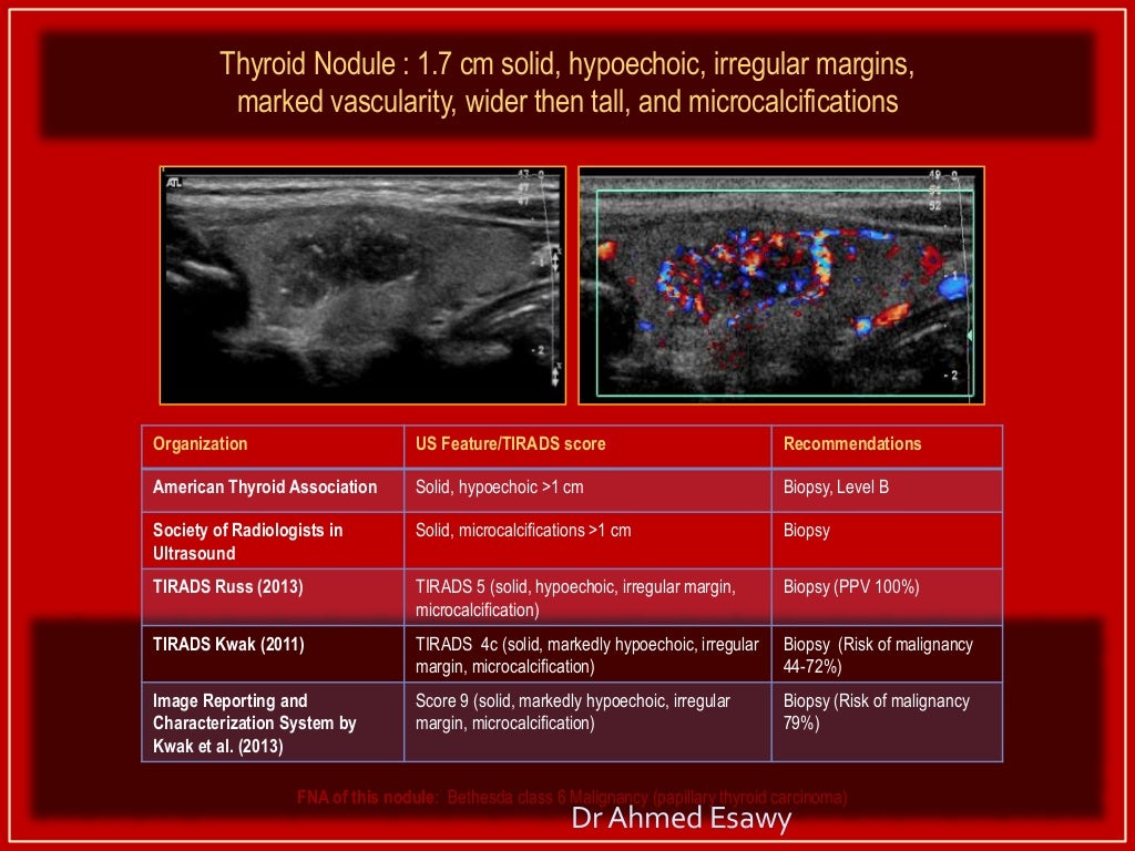 TIRADS (thyroid nodule imaging reporting and data system) Dr Ahmed E…