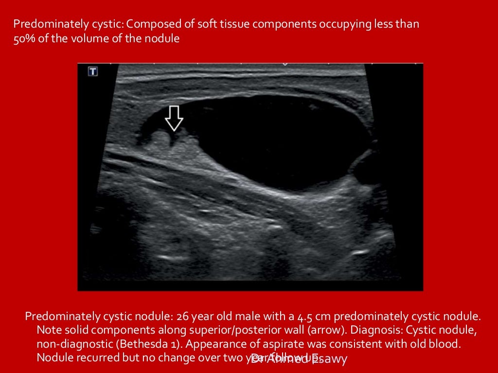 TIRADS (thyroid nodule imaging reporting and data system) Dr Ahmed E…