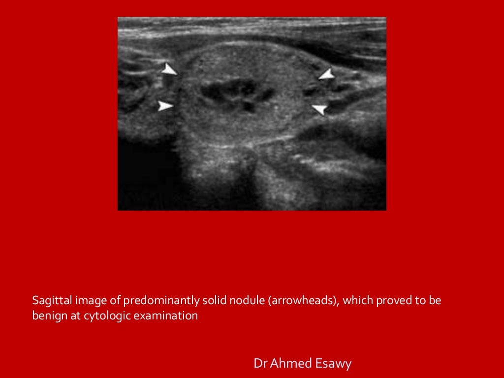 TIRADS (thyroid nodule imaging reporting and data system) Dr Ahmed E…