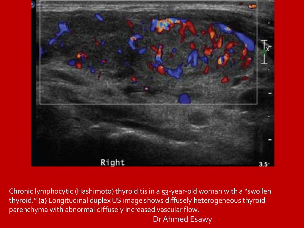 TIRADS (thyroid nodule imaging reporting and data system) Dr Ahmed E…