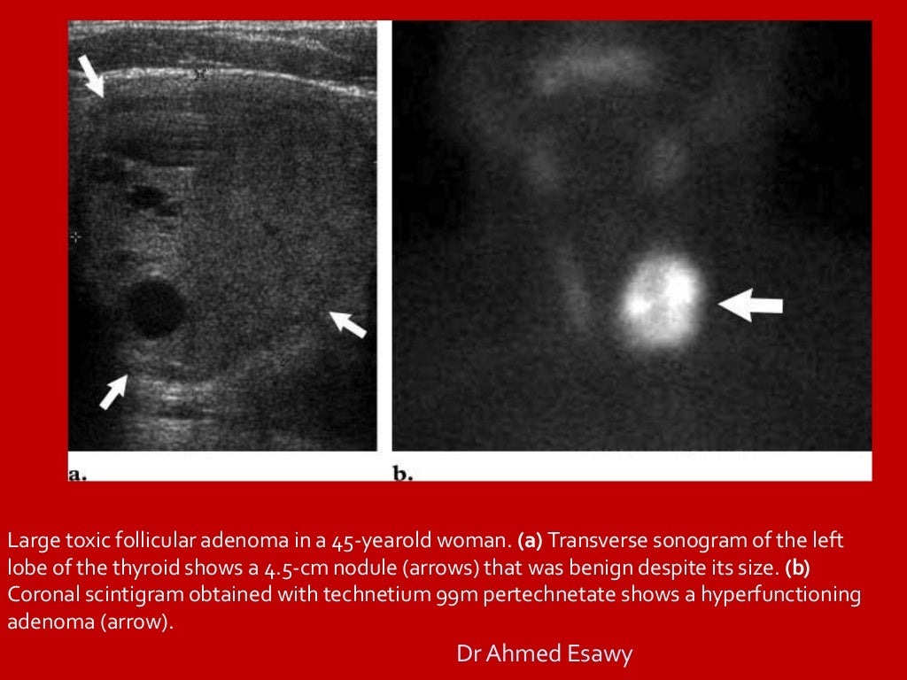 TIRADS (thyroid nodule imaging reporting and data system) Dr Ahmed E…