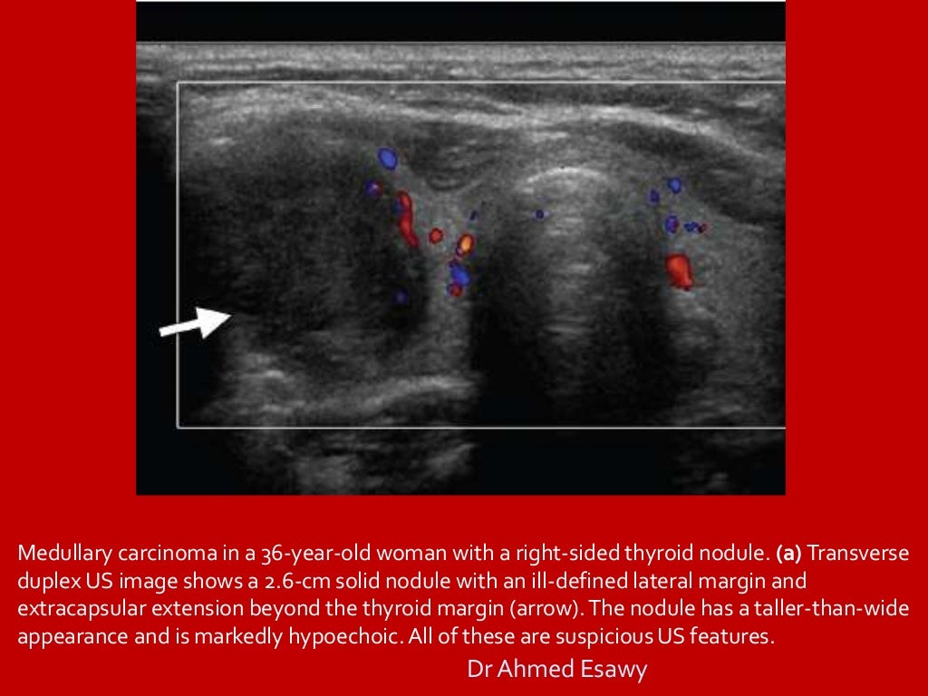 Tirads Thyroid Nodule Imaging Reporting And Data System Dr Ahmed E