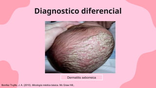 Tiña capitis y corporis en pediatria.pptx