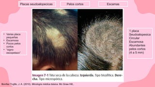Tiña capitis y corporis en pediatria.pptx