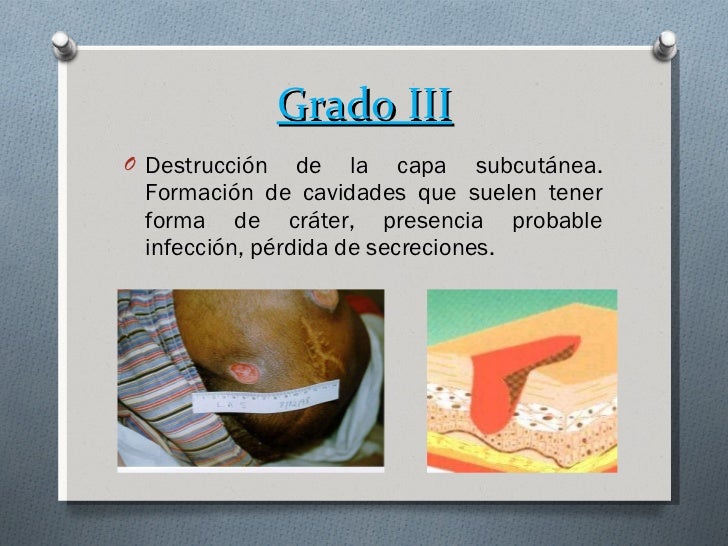 Ulceras por presión. Prevención, diagnóstico y tratamiento.