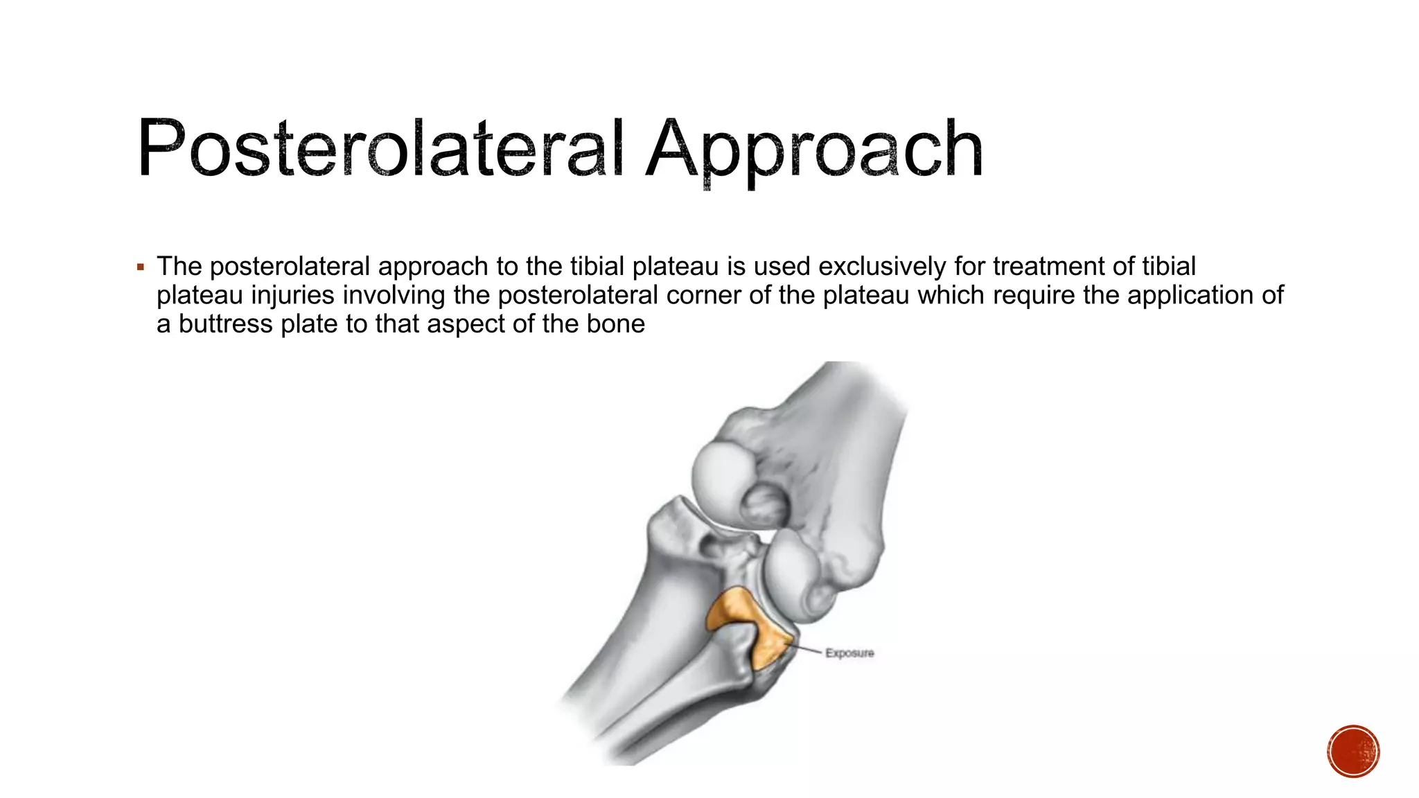 Proximal Tibia Surgical approaches | PPTX