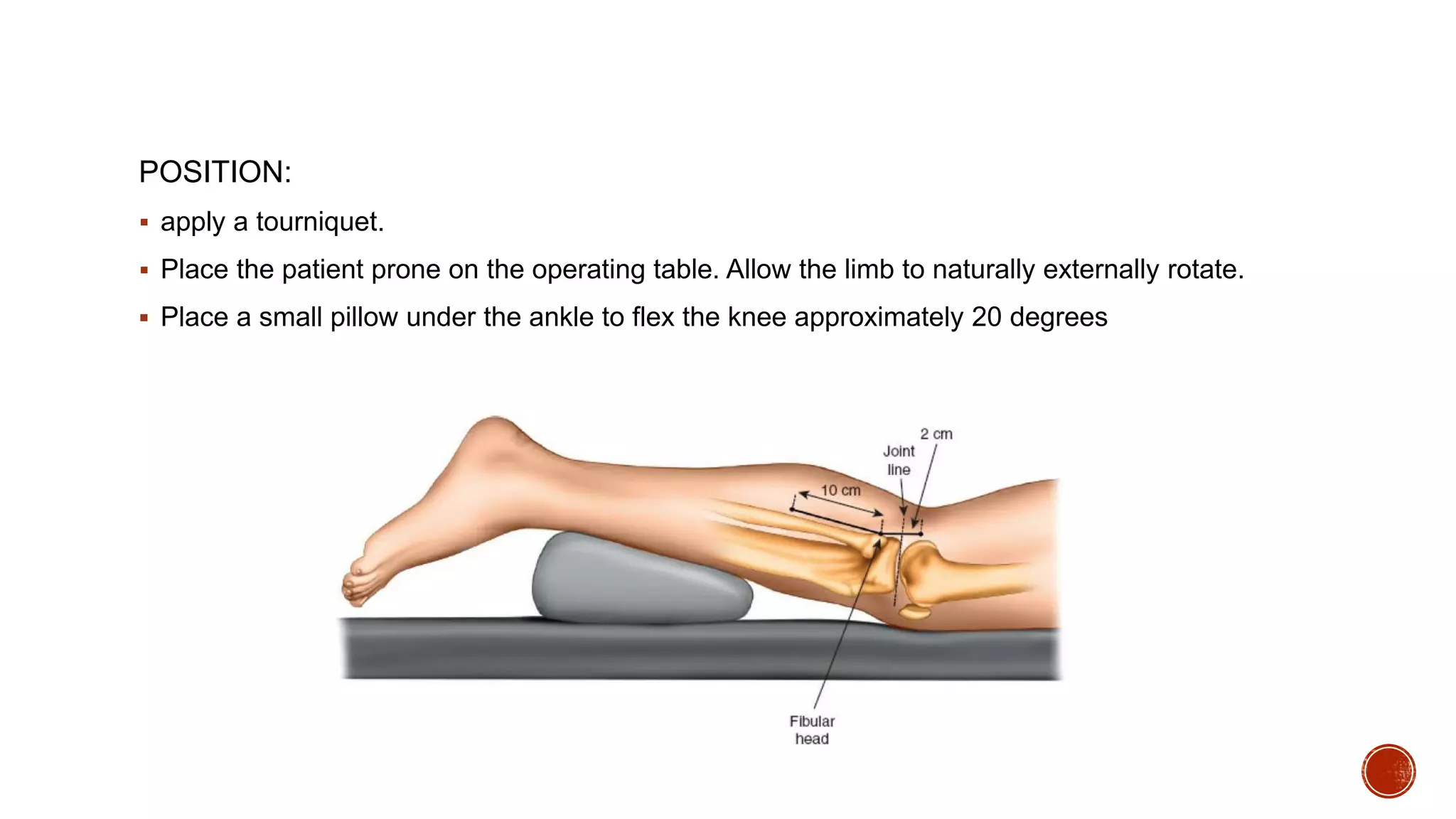 Proximal Tibia Surgical approaches | PPTX