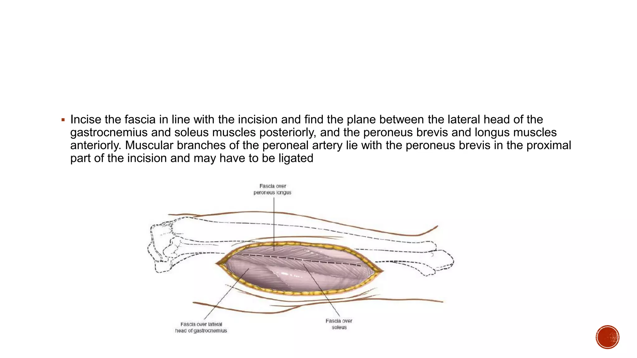 Proximal Tibia Surgical approaches | PPTX