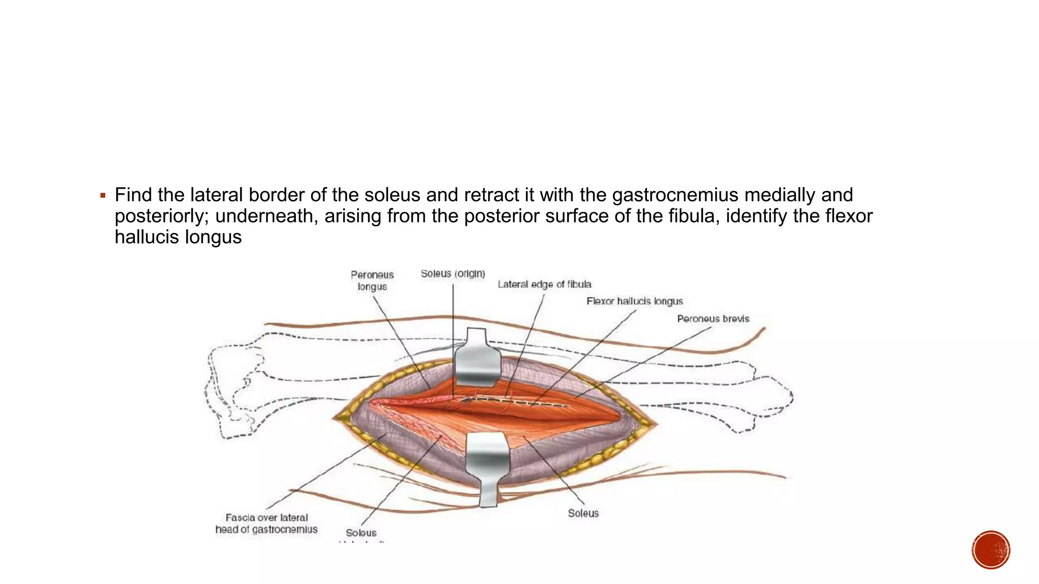 Proximal Tibia Surgical approaches | PPTX