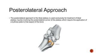 Proximal Tibia Surgical approaches | PPTX