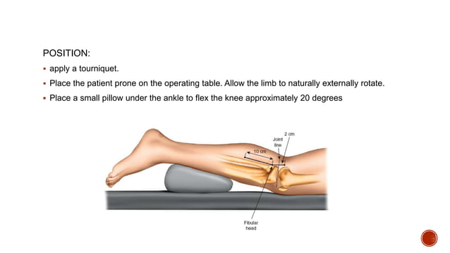 Proximal Tibia Surgical approaches | PPTX | Death, Injury, or Military ...