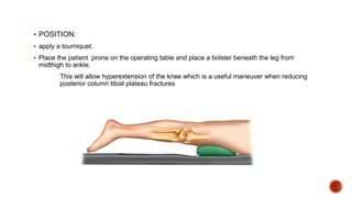 Proximal Tibia Surgical approaches | PPTX