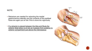 Proximal Tibia Surgical approaches | PPTX