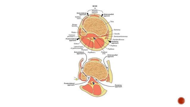 Proximal Tibia Surgical approaches | PPTX | Death, Injury, or Military ...