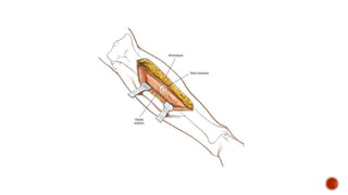 Proximal Tibia Surgical approaches | PPTX