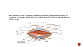 Proximal Tibia Surgical approaches | PPTX