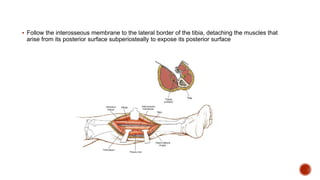 Proximal Tibia Surgical approaches | PPTX