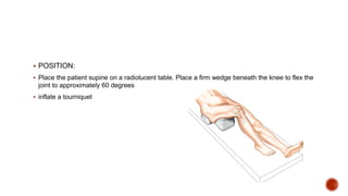 Proximal Tibia Surgical approaches | PPTX