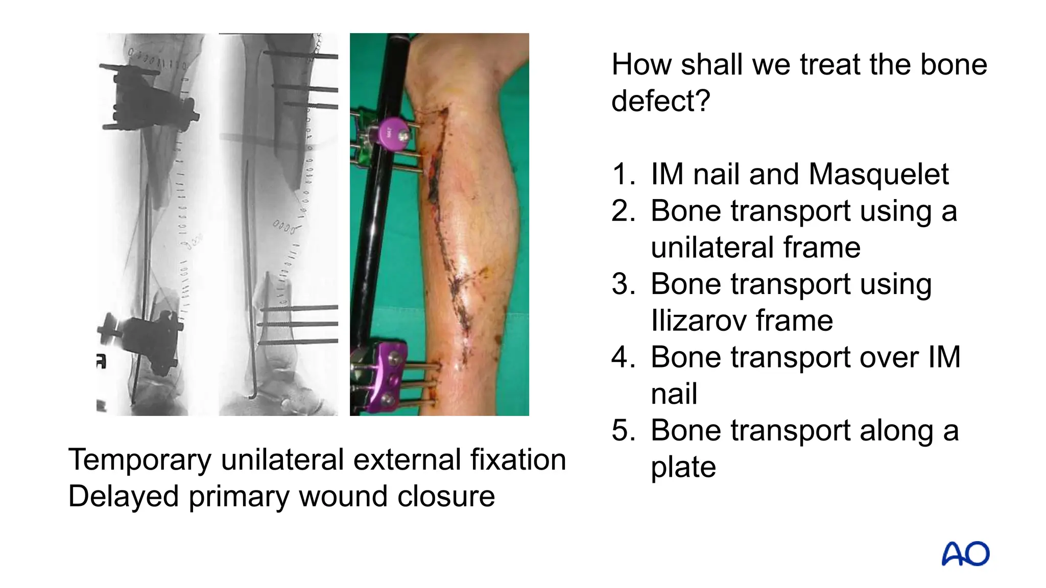 Tibia Defect Transportation Nail_Oct52018.pptx