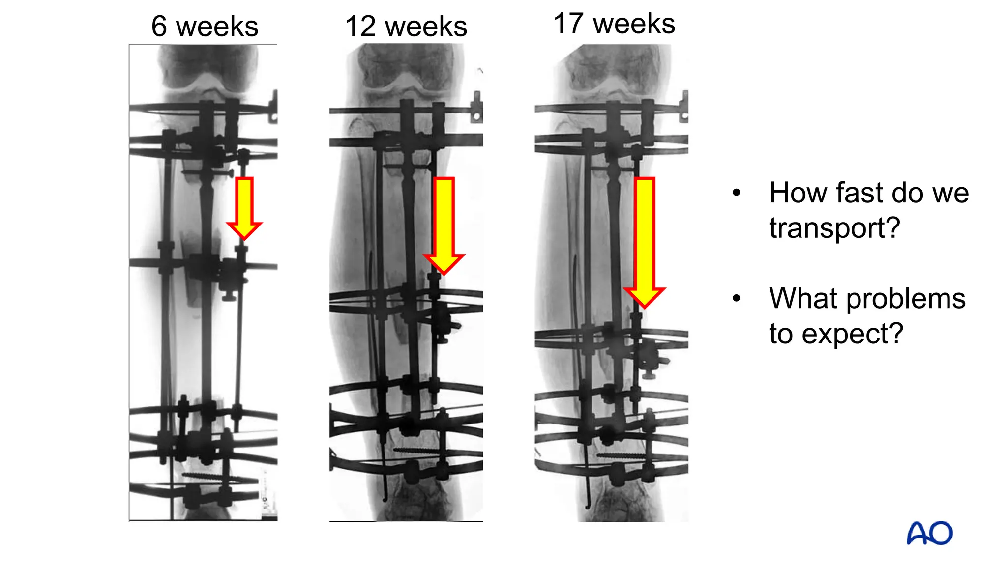 Tibia Defect Transportation Nail_Oct52018.pptx