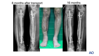 Tibia Defect Transportation Nail_Oct52018.pptx