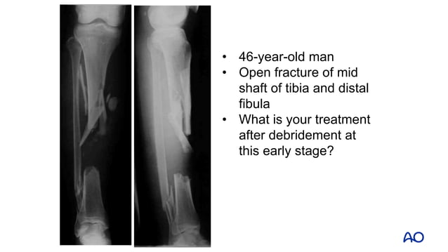 Tibia Defect Transportation Nail_Oct52018.pptx