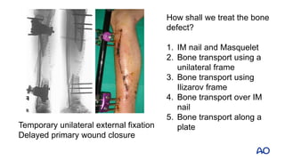Tibia Defect Transportation Nail_Oct52018.pptx