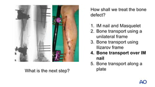 Tibia Defect Transportation Nail_Oct52018.pptx