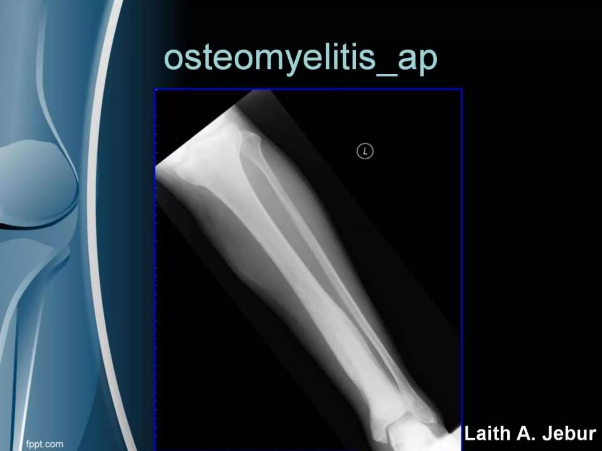 Orthopedics Of Tibia & fibula | PPT