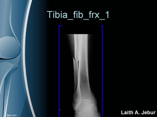 Orthopedics Of Tibia & fibula | PPT