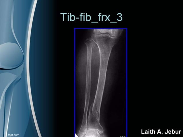 Orthopedics Of Tibia & fibula | PPT