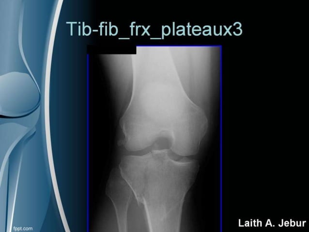 Orthopedics Of Tibia & fibula | PPT