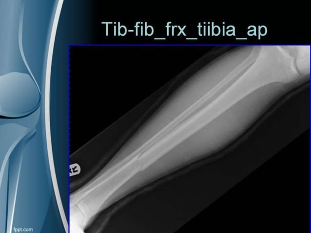 Orthopedics Of Tibia & fibula | PPT