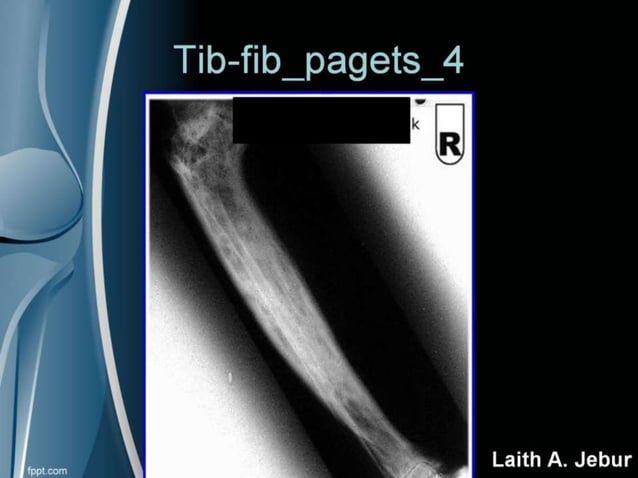 Orthopedics Of Tibia & fibula | PPT