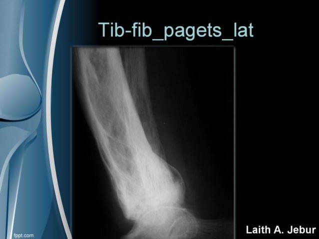 Orthopedics Of Tibia & fibula | PPT