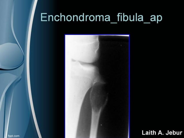 Orthopedics Of Tibia & fibula | PPT