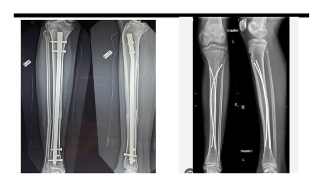Tibia Fracture classification and management | PPTX