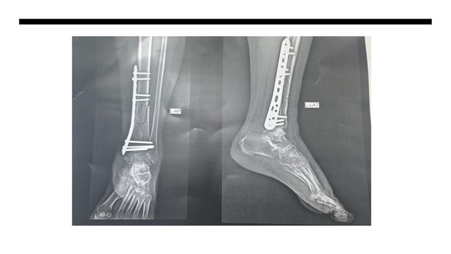 Tibia Fracture classification and management | PPTX
