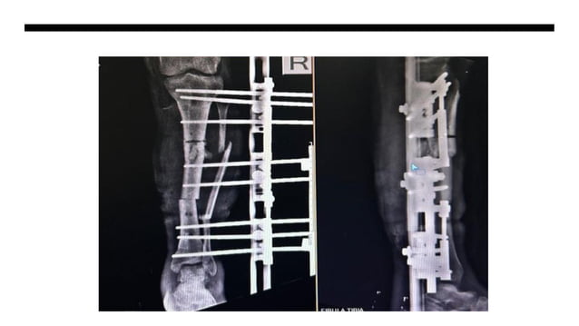 Tibia Fracture classification and management | PPTX